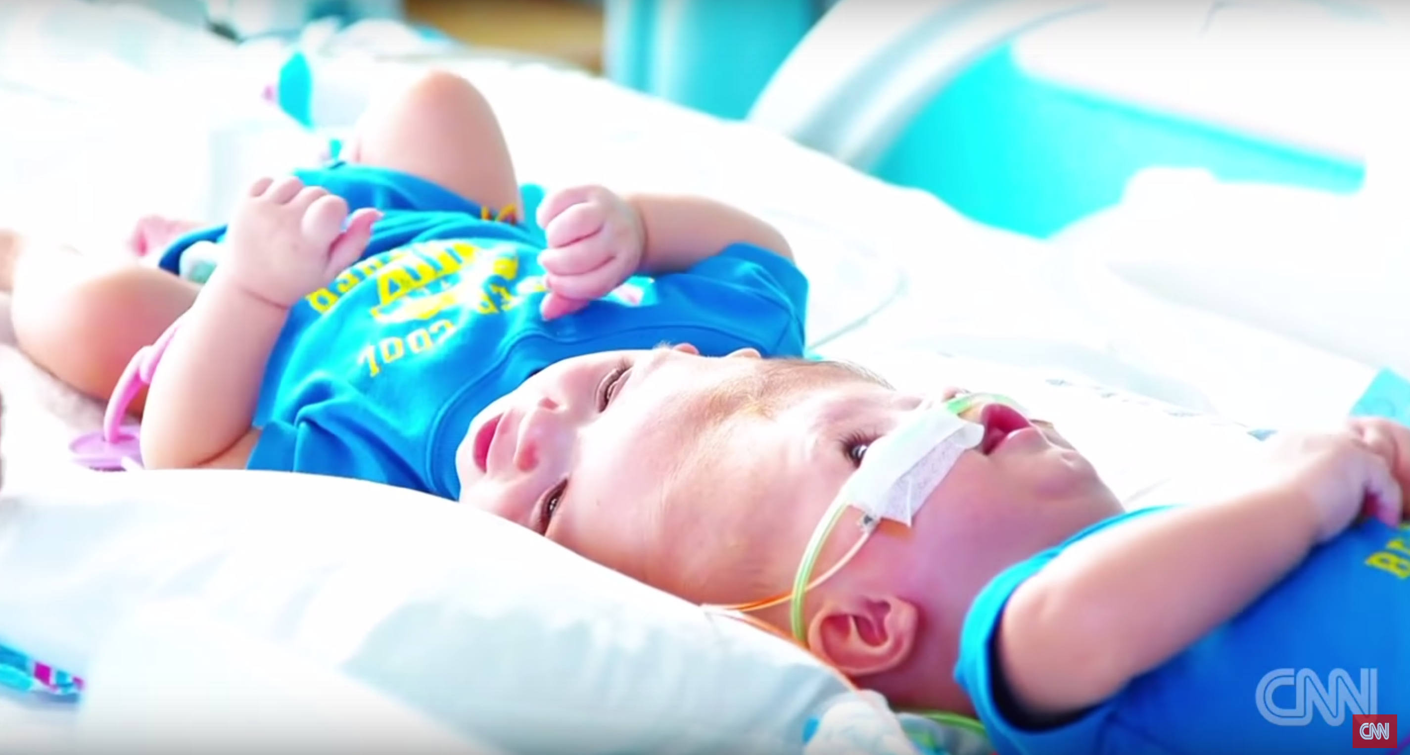 Conjoined Twins to Be Separated in Rare Surgery | Inverse