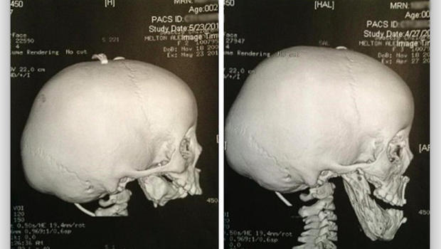 Doctors Create a New Jaw For A Girl Born Without One | Inverse