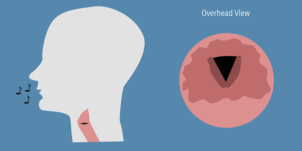 Vocal Cord Tissue Implant Could Help Treat Voice Disorders | Inverse