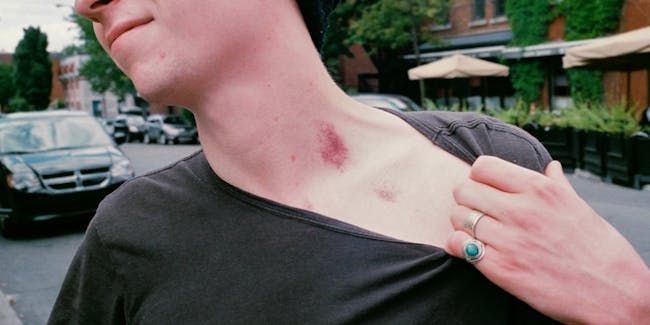Science Explains How A Hickey Can Kill You Inverse