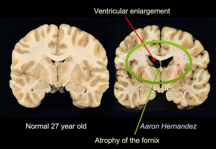 Aaron Hernandezs Cte Doctors Present Dramatic New Findings Inverse