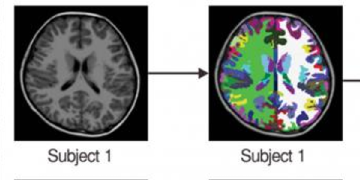 Study on the Brains of ADHD Patients Has Implications for the Adderall ...