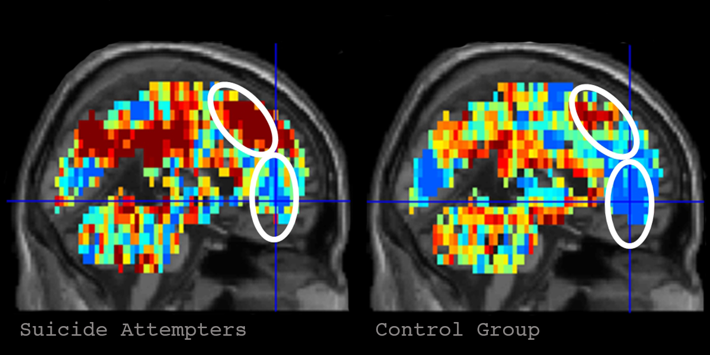 Brain Scans Can Now Identify People With Suicidal Thoughts | Inverse